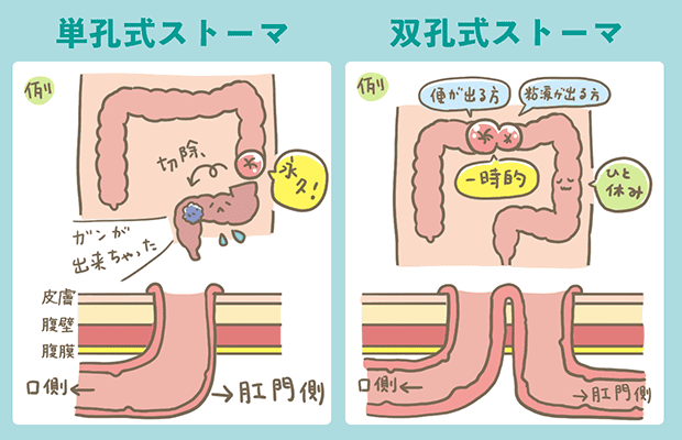 ストーマとは？適応や種類、看護のポイントについて解説｜レバウェル看護 お役立ち情報