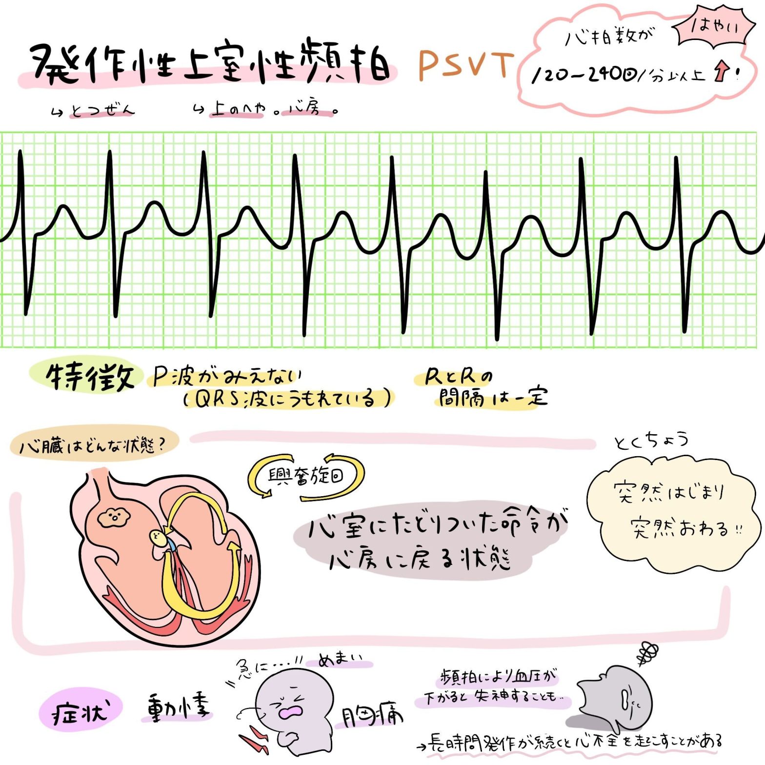 【不整脈波形】心室性期外収縮（PVC）と発作性上室性頻拍（PSVT）を看護師がイラストで解説！｜レバウェル看護 お役立ち情報